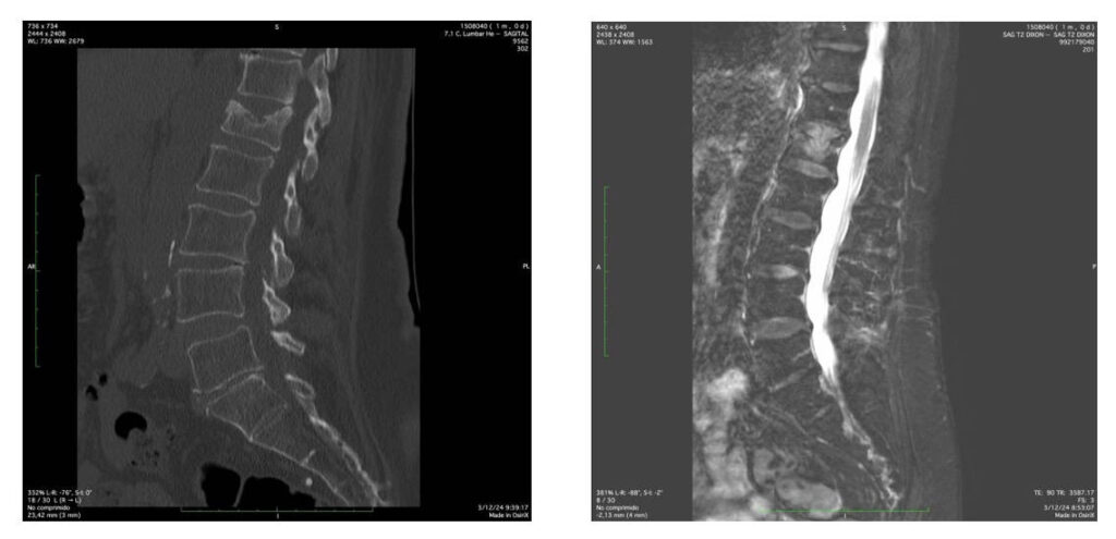 Fracturas osteoporóticas - Vertebroplastia - Cifoplastia - Unidad de ...