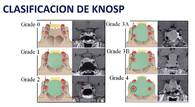 Adenoma de hipófisis - Tratamiento - Unidad de Neurocirugía RGS