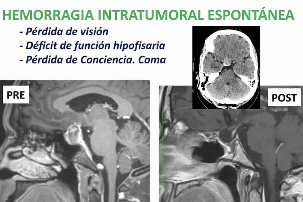 Adenoma de hipófisis - Tratamiento - Unidad de Neurocirugía RGS